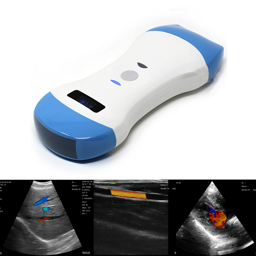 MS-W100 Wireless Probe Type Ultrasound Scanner - Buy Digital Ultrasound Scanner, Portable ...